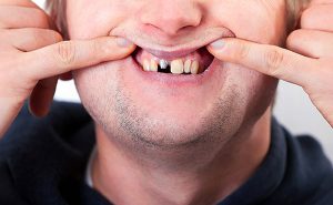 Crown recement | Dentist in Watford | Herts Dental Clinic – Family ...
